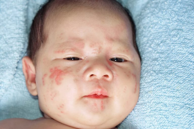 Skin Color and Texture - Birth Disorders